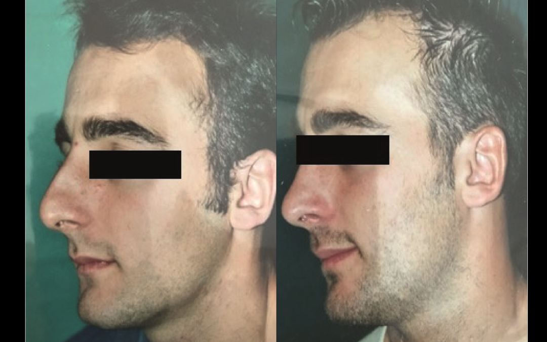 AP - Rhinoplastie Archives - Dr Alain Ankri