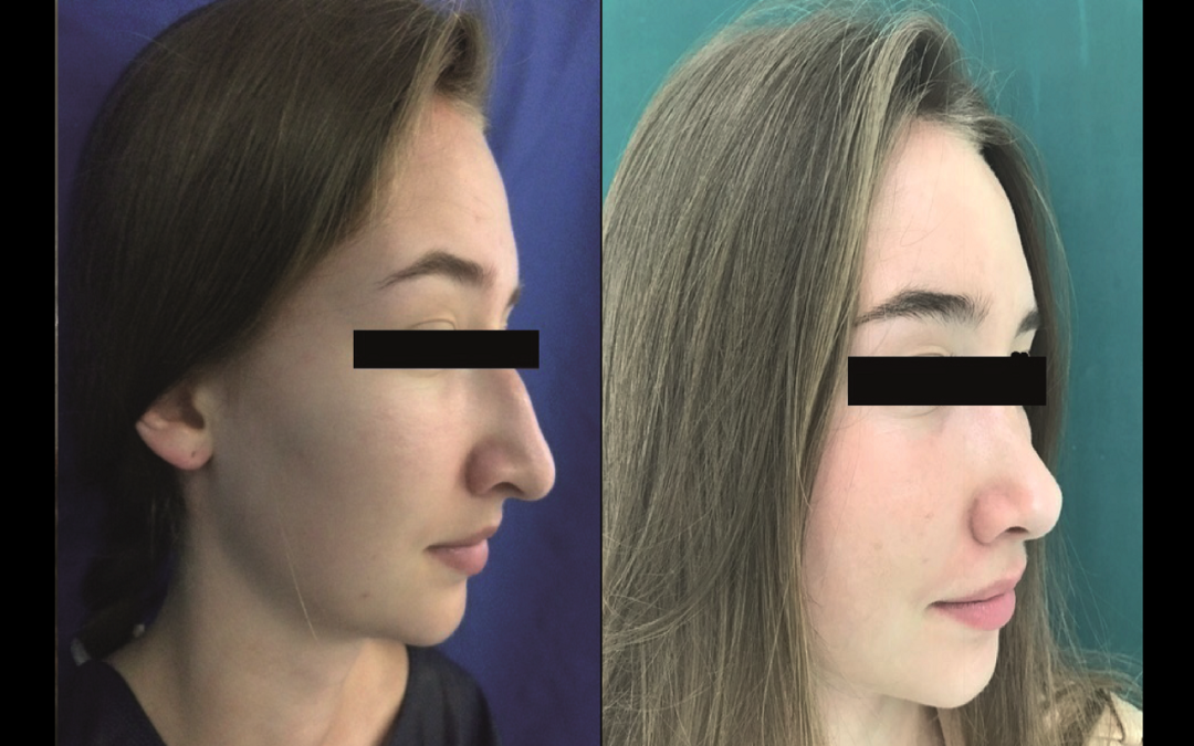 AP - Rhinoplastie Archives - Dr Alain Ankri